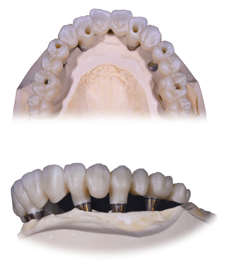 KATANA™ Zirconia YML: Empower Your Dental Lab with Multi-Layered Zirconia