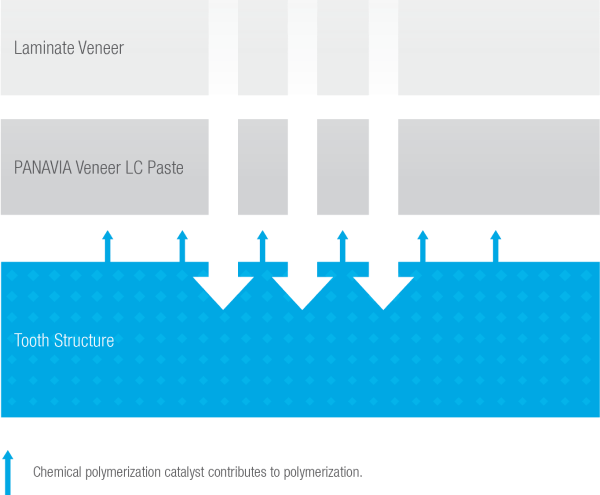 Highly esthetic, light-curing PANAVIA Veneer LC cement