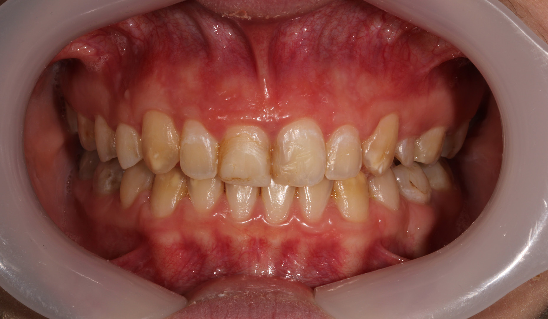 Porcelain System for Micro-Layering in Dental Restorations