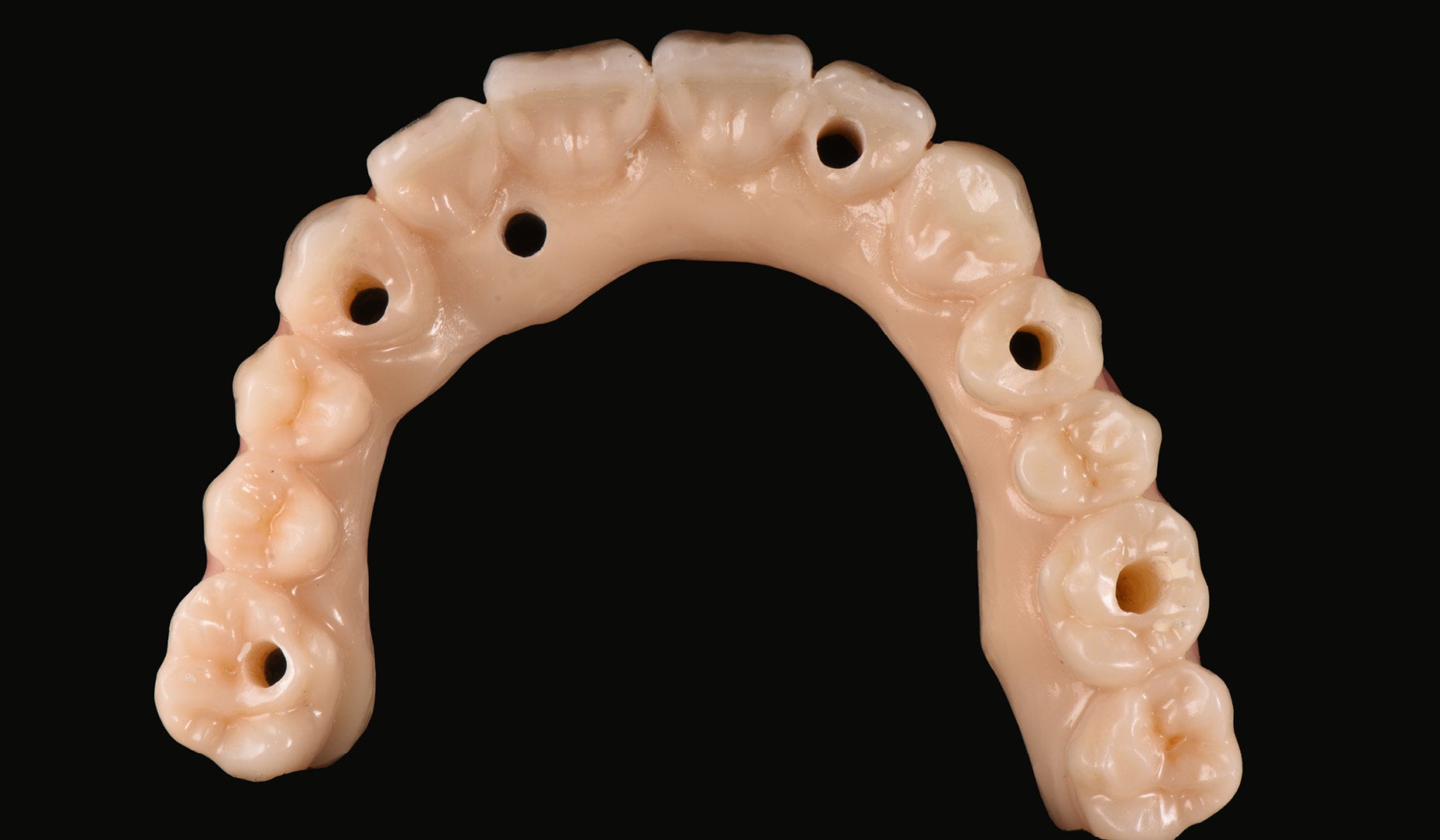 Micro-Layering for Zirconia Implant Prostheses | Case Study