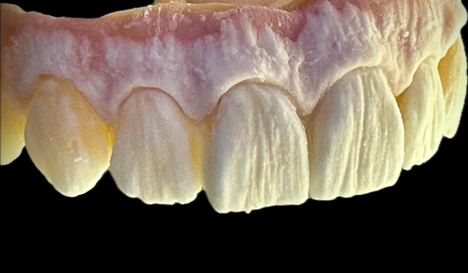 Micro-Layering for Zirconia Implant Prostheses | Case Study