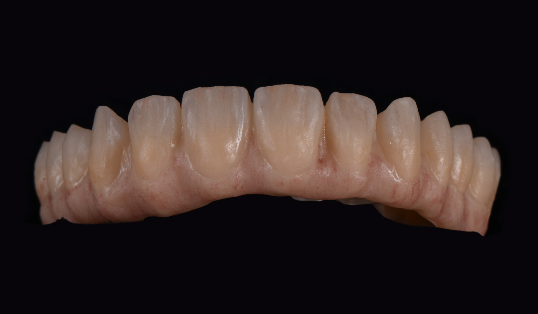 Micro-Layering for Implant Restorations with CERABIEN MiLai