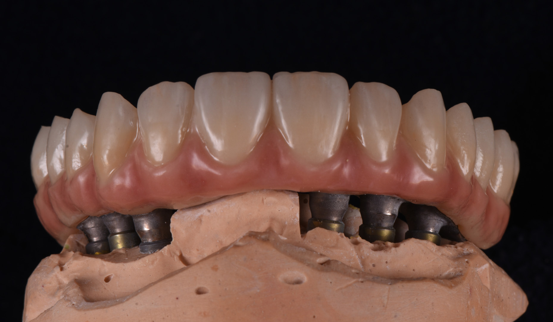 Micro-Layering for Implant Restorations with CERABIEN MiLai