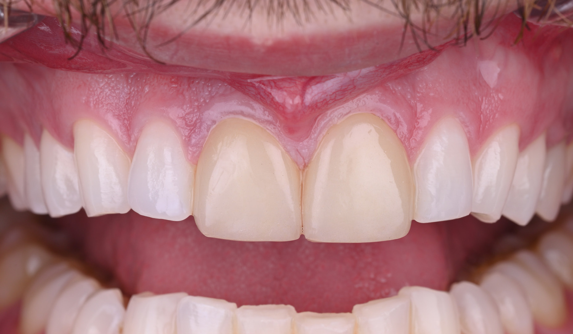 Full & Partial Laminate Veneers: Aesthetic Smile Restoration