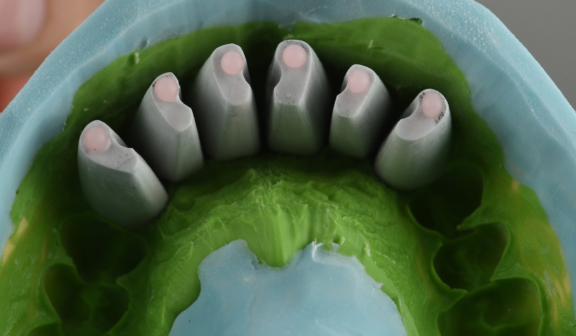 Full & Partial Laminate Veneers: Aesthetic Smile Restoration