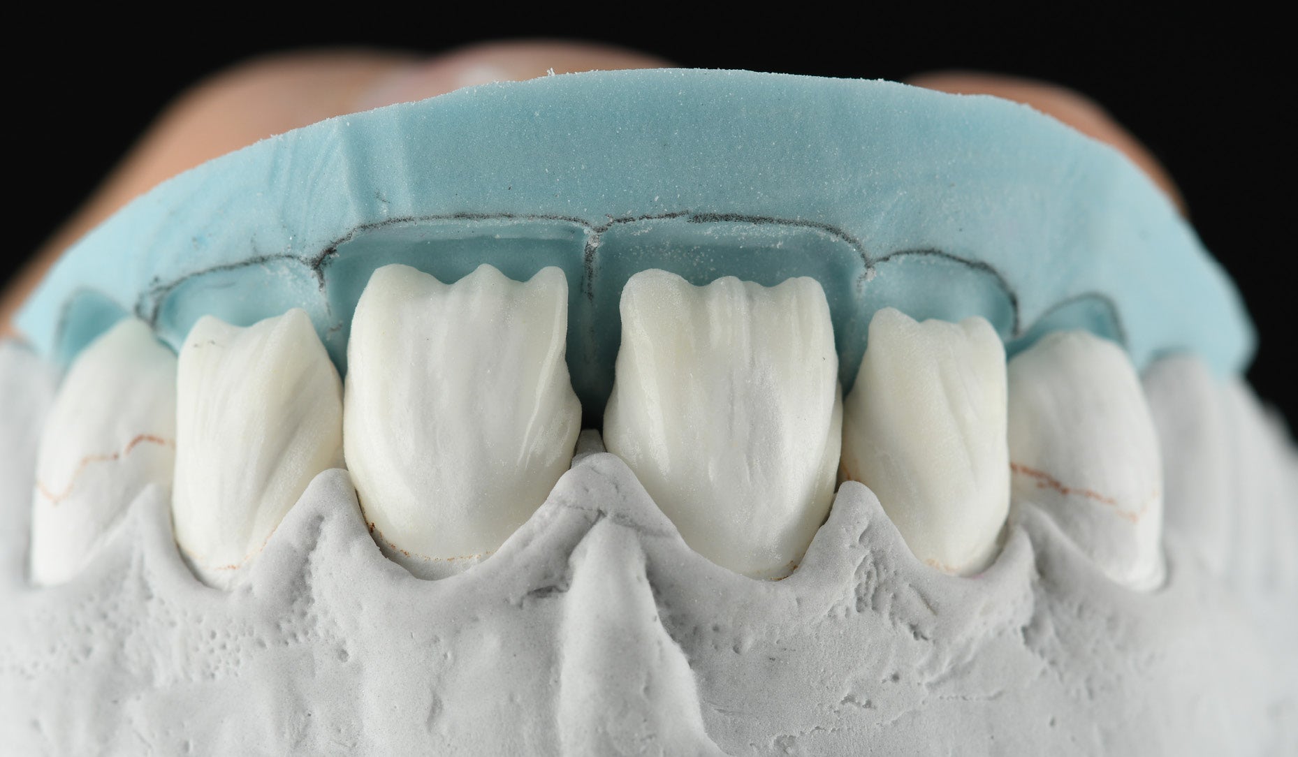 Full & Partial Laminate Veneers: Aesthetic Smile Restoration