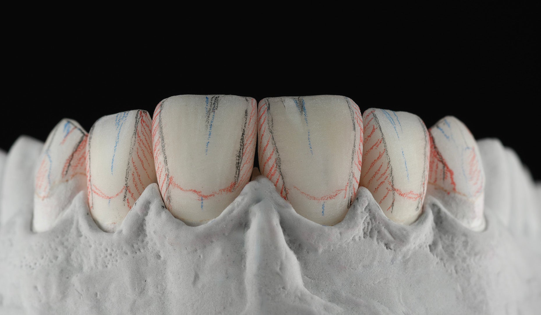 Full & Partial Laminate Veneers: Aesthetic Smile Restoration