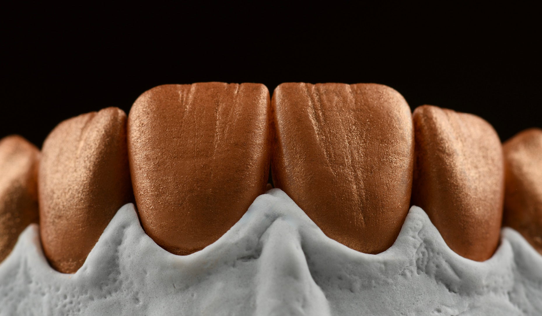 Full & Partial Laminate Veneers: Aesthetic Smile Restoration