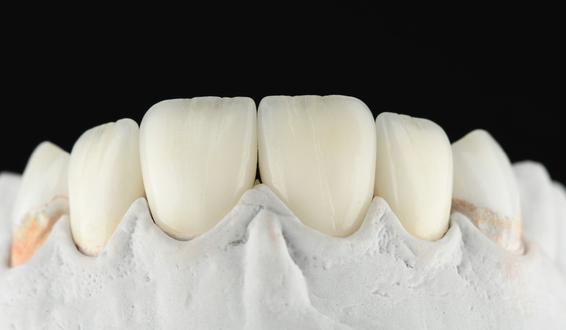 Full & Partial Laminate Veneers: Aesthetic Smile Restoration