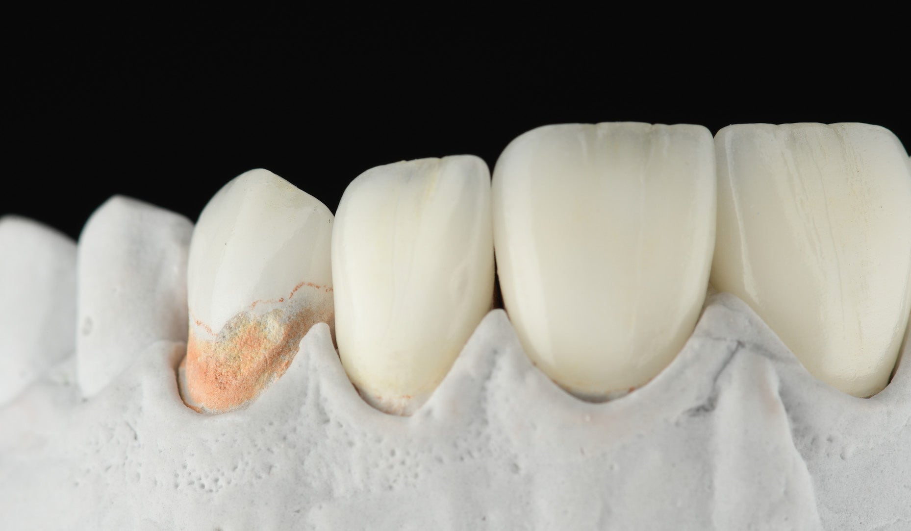 Full & Partial Laminate Veneers: Aesthetic Smile Restoration