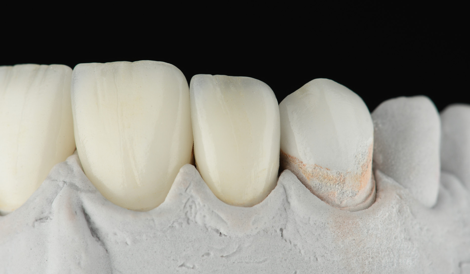 Full & Partial Laminate Veneers: Aesthetic Smile Restoration