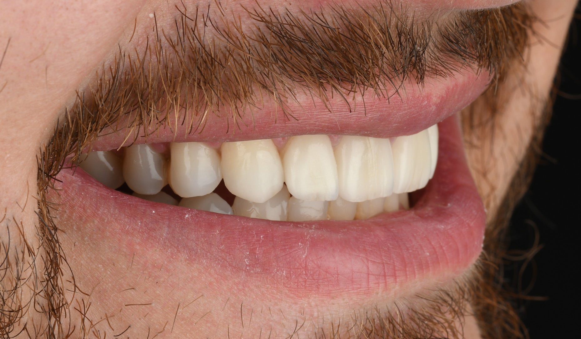 Full & Partial Laminate Veneers: Aesthetic Smile Restoration