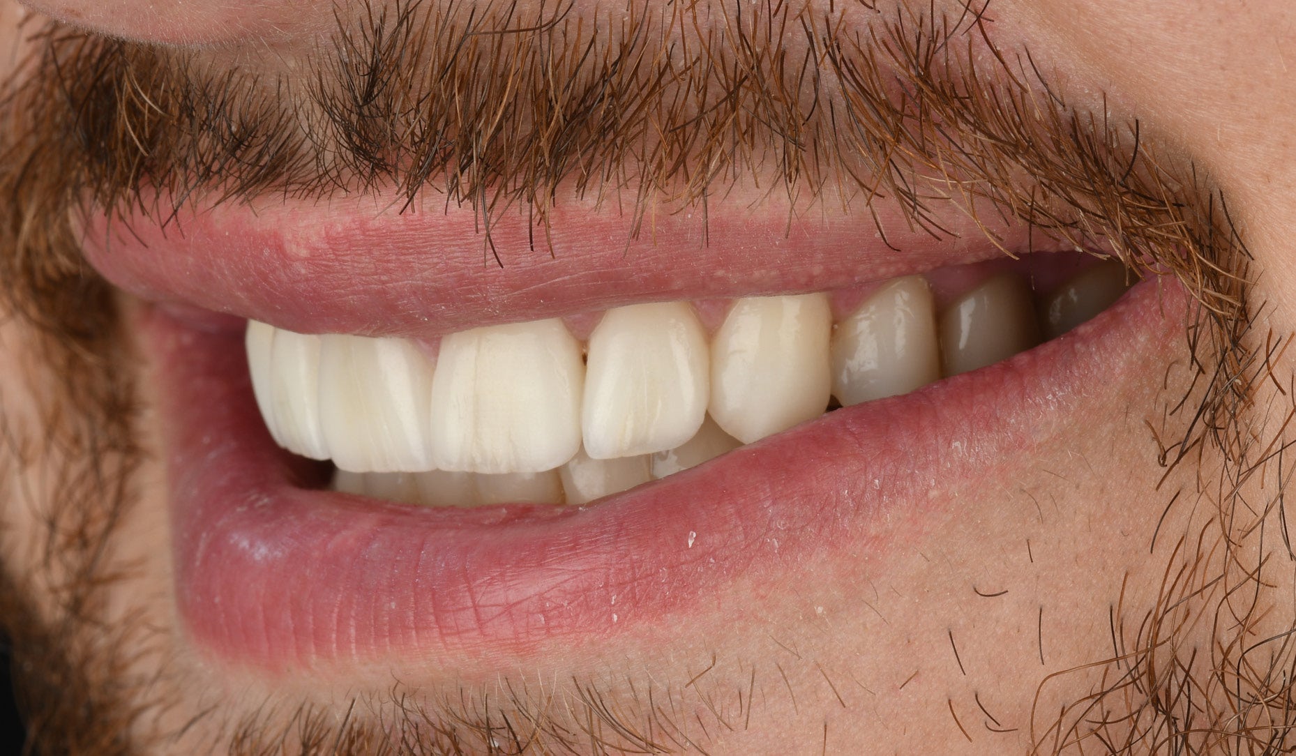 Full & Partial Laminate Veneers: Aesthetic Smile Restoration