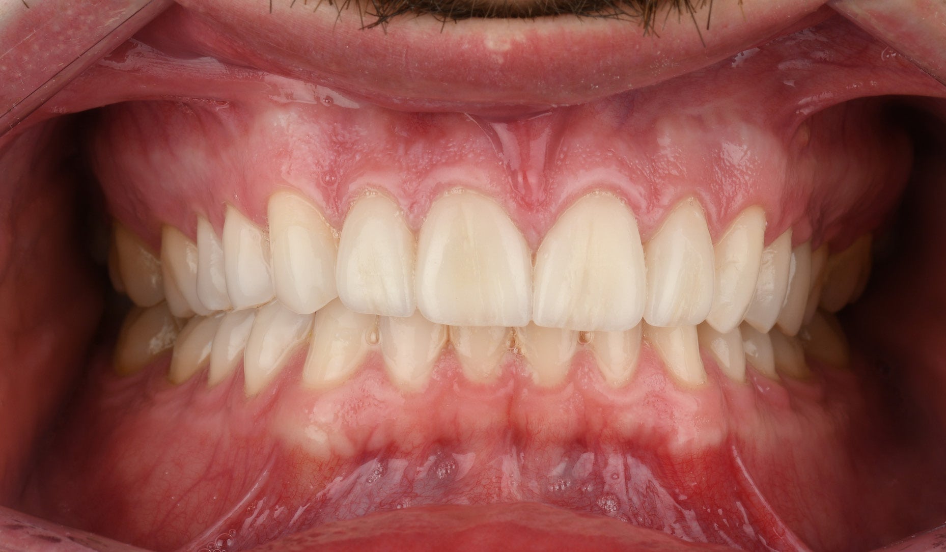 Full & Partial Laminate Veneers: Aesthetic Smile Restoration