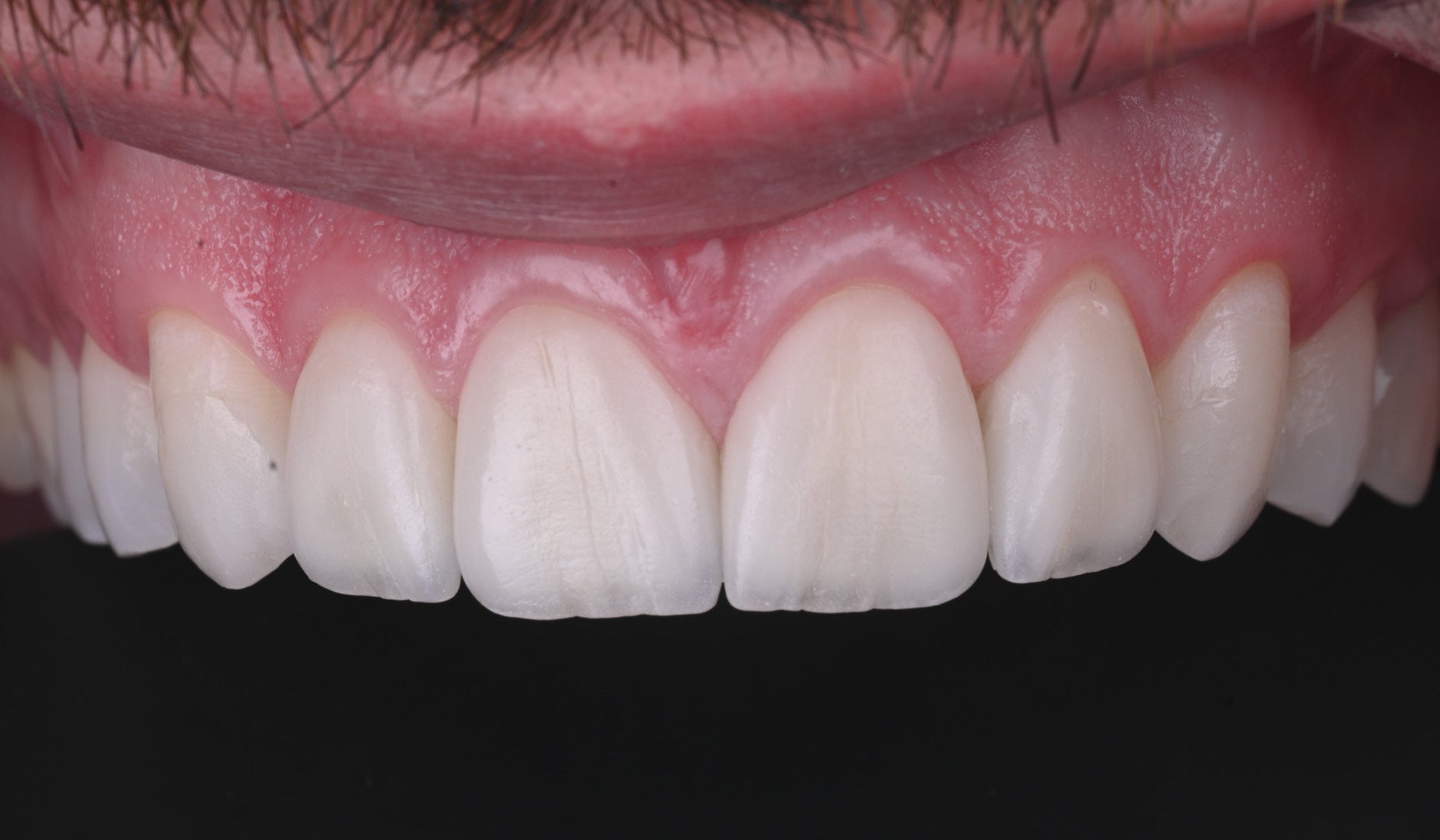 Full & Partial Laminate Veneers: Aesthetic Smile Restoration