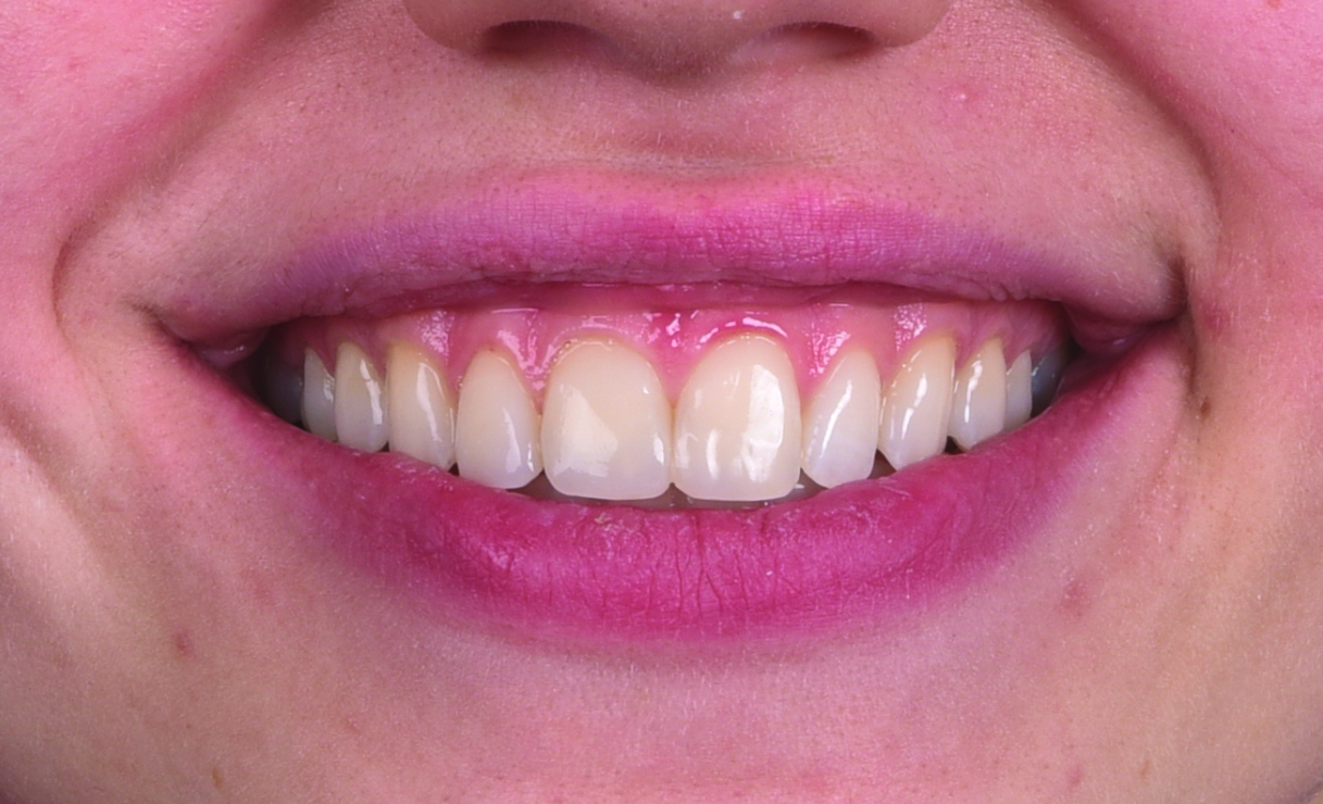 Clinical case with CLEARFIL MAJESTY™ ES-2