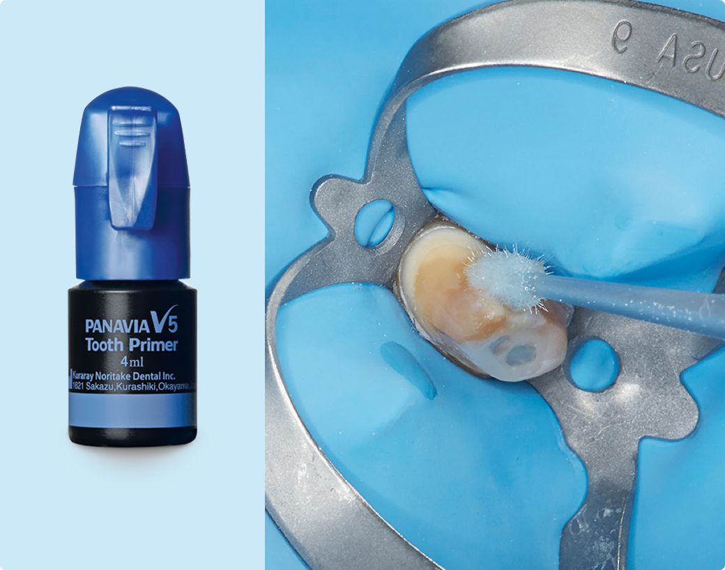 PANAVIA V5 | el cemento adhesivo más potente